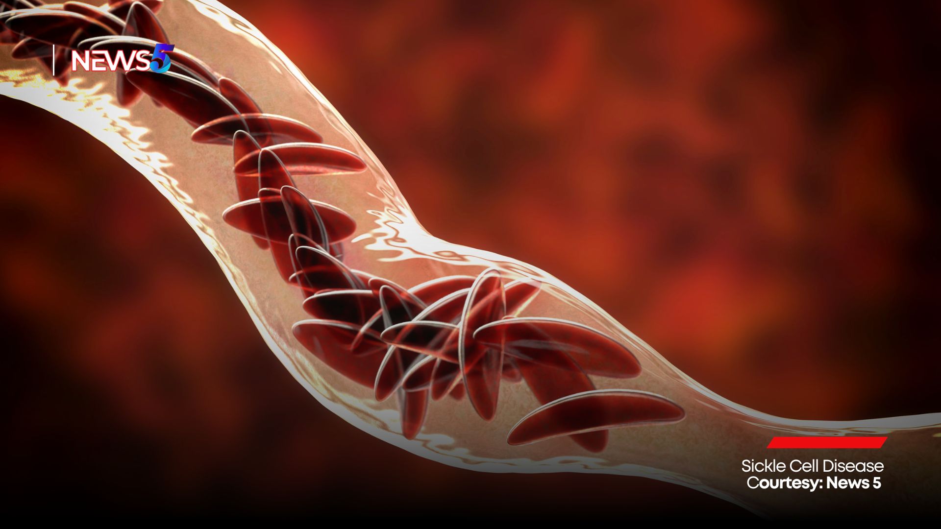 Understanding Sickle Cell Disease | Greater Belize Media