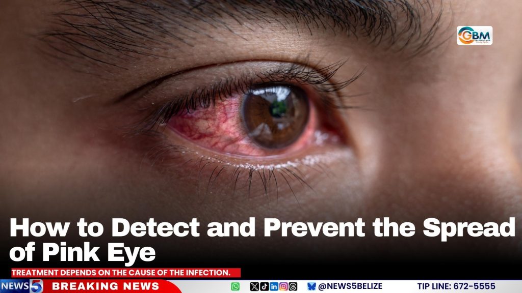 How to Detect and Prevent the Spread of Pink Eye | Greater Belize Media